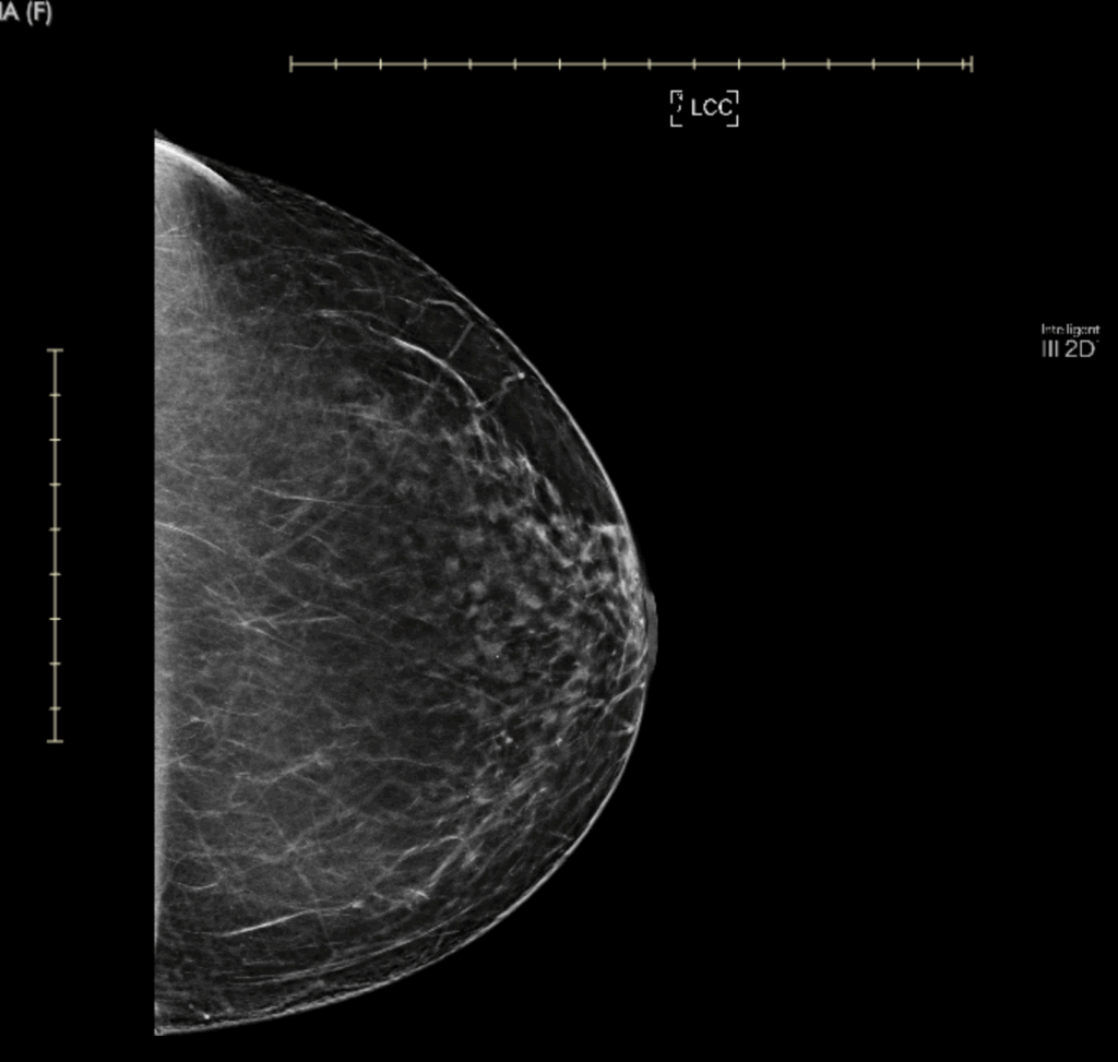Mammogram Risks: Under & Overdiagnosis, Radiation, Compression, and ...
